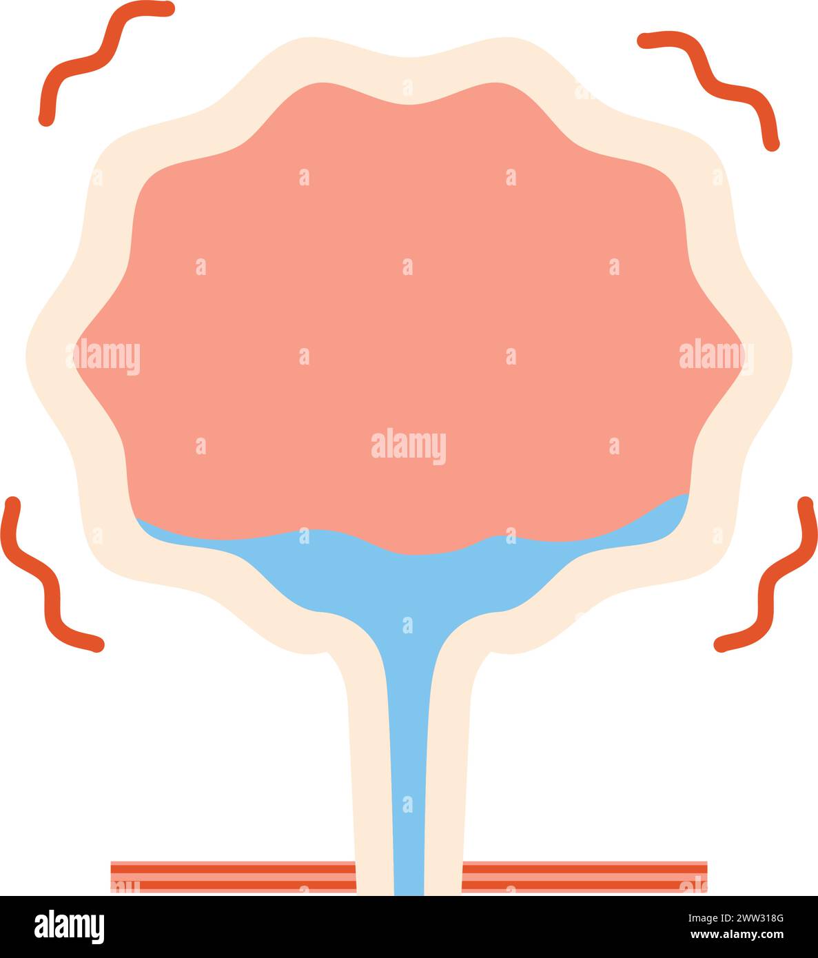 Medical illustration of overactive bladder, a condition in which the ...