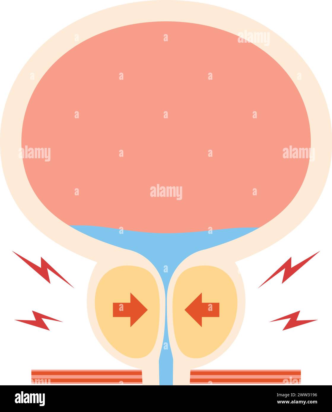Medical illustration of benign prostatic hyperplasia, enlarged prostate ...