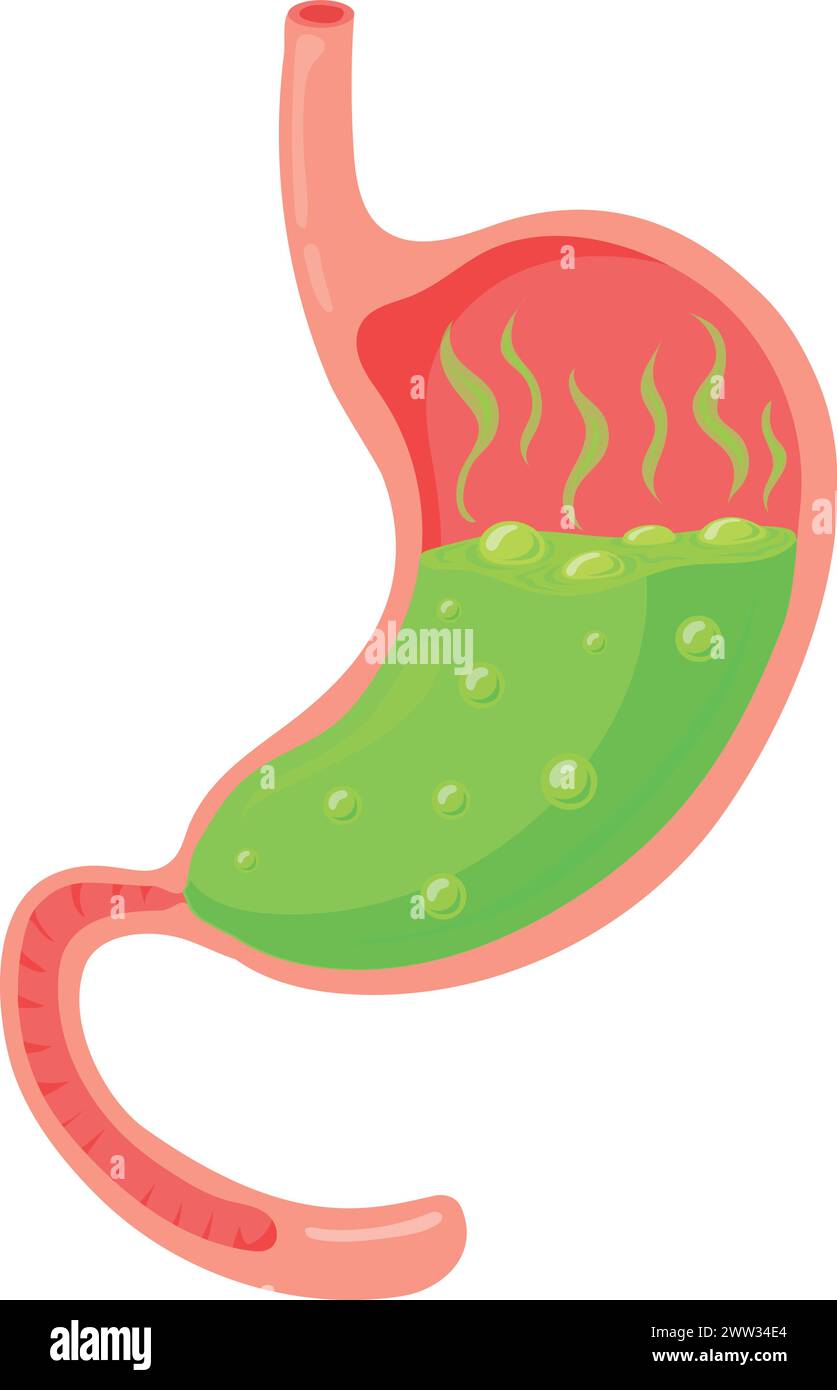 Acid stomach. Reflux symptome. Digestive pain illustration isolated on ...