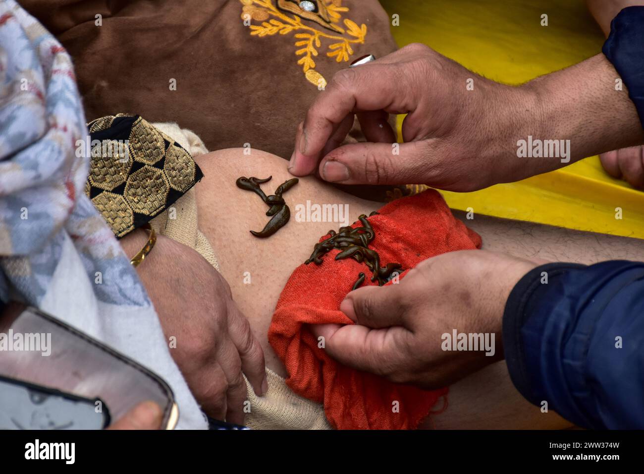 Srinagar, India. 21st Mar, 2024. A patient receives a leech therapy on ...