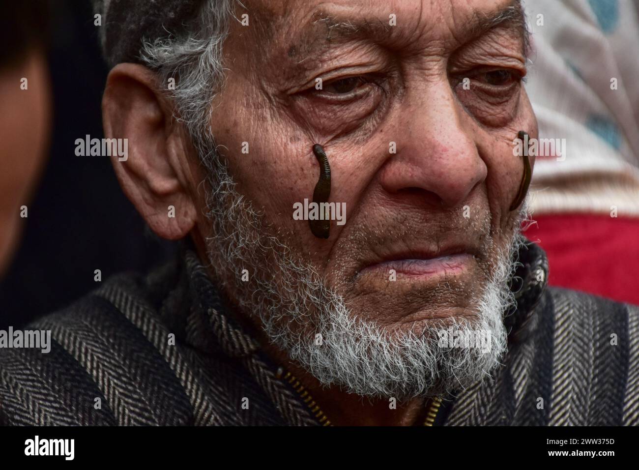 Srinagar, India. 21st Mar, 2024. A patient receives a leech therapy on ...