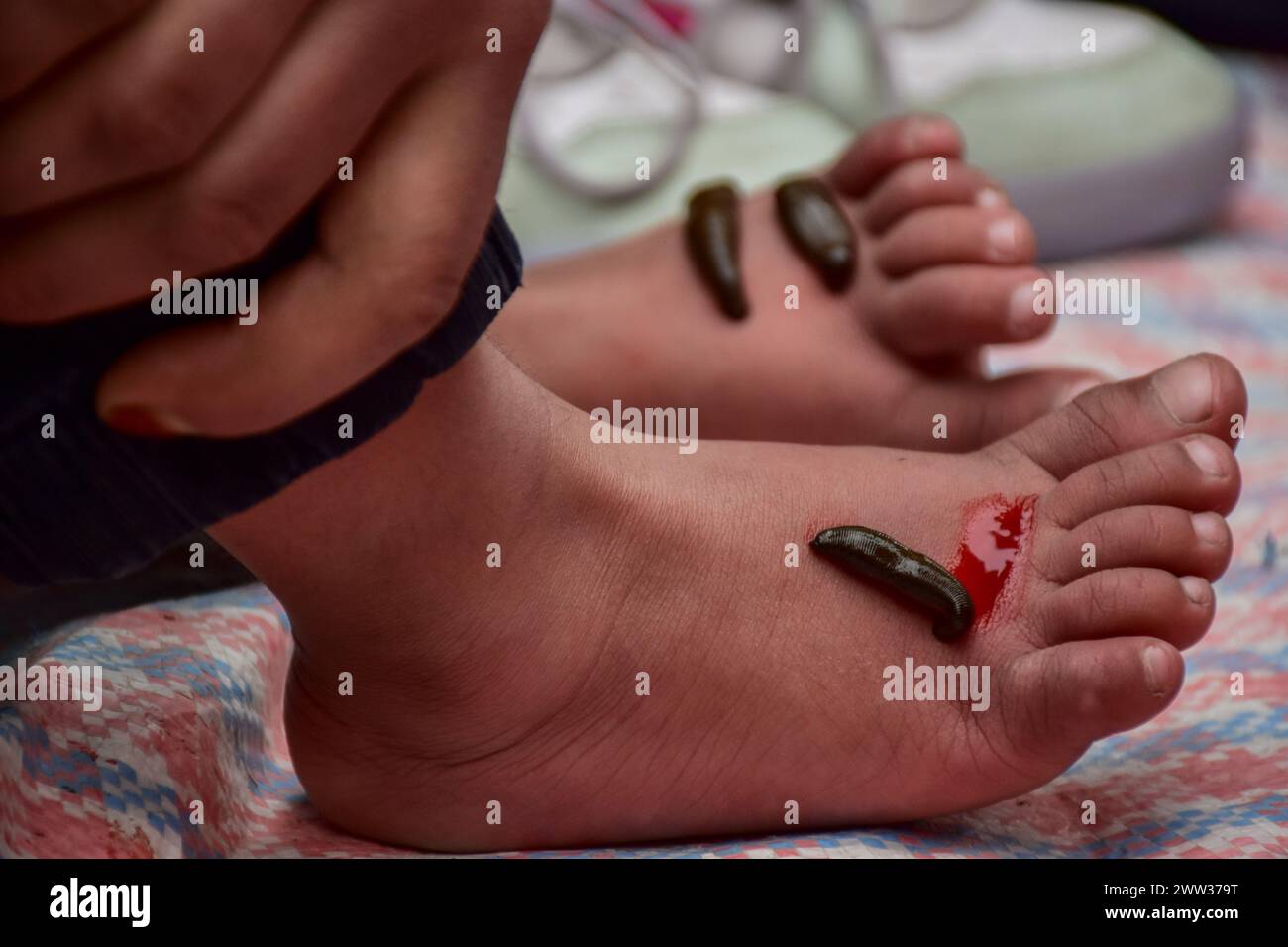Srinagar, India. 21st Mar, 2024. A child receives a leech therapy on ...
