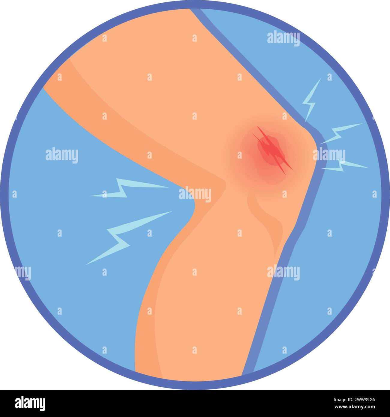 Knee injury wound. Medical leg pain illustration isolated on white ...
