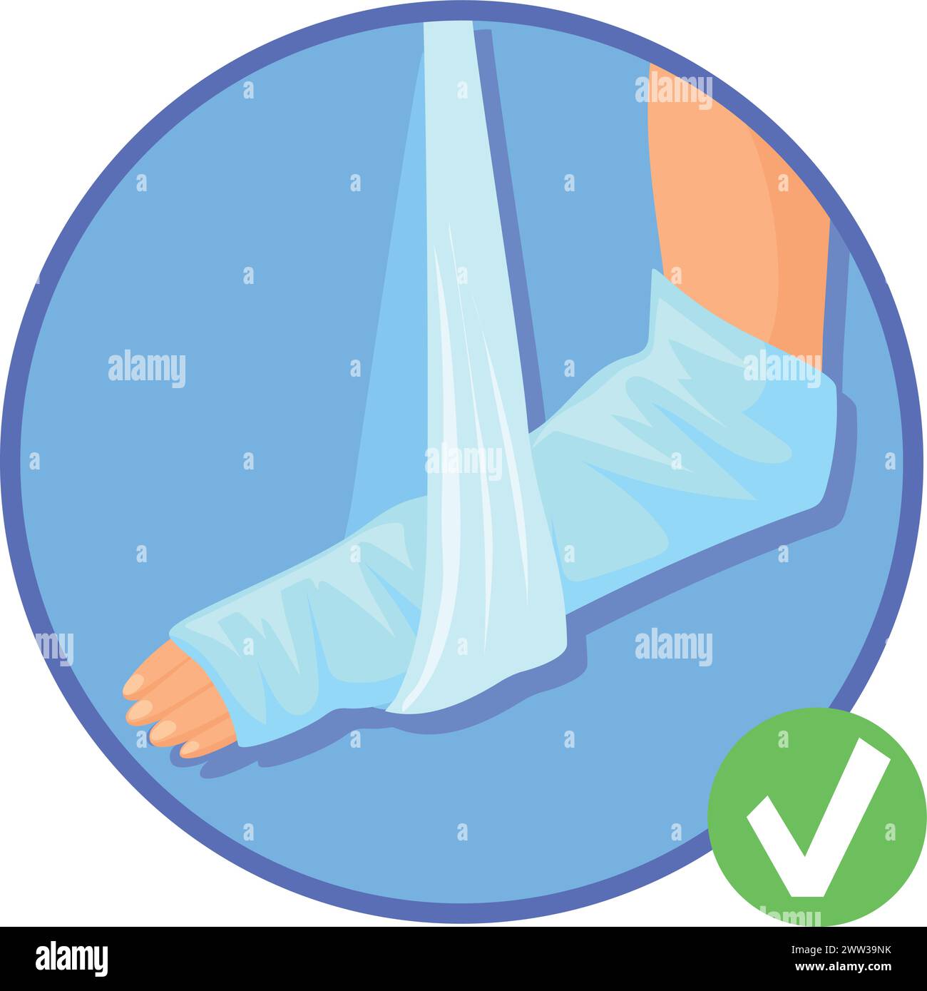 Hand in plaster cast. Broken bone medical bandage isolated on white ...