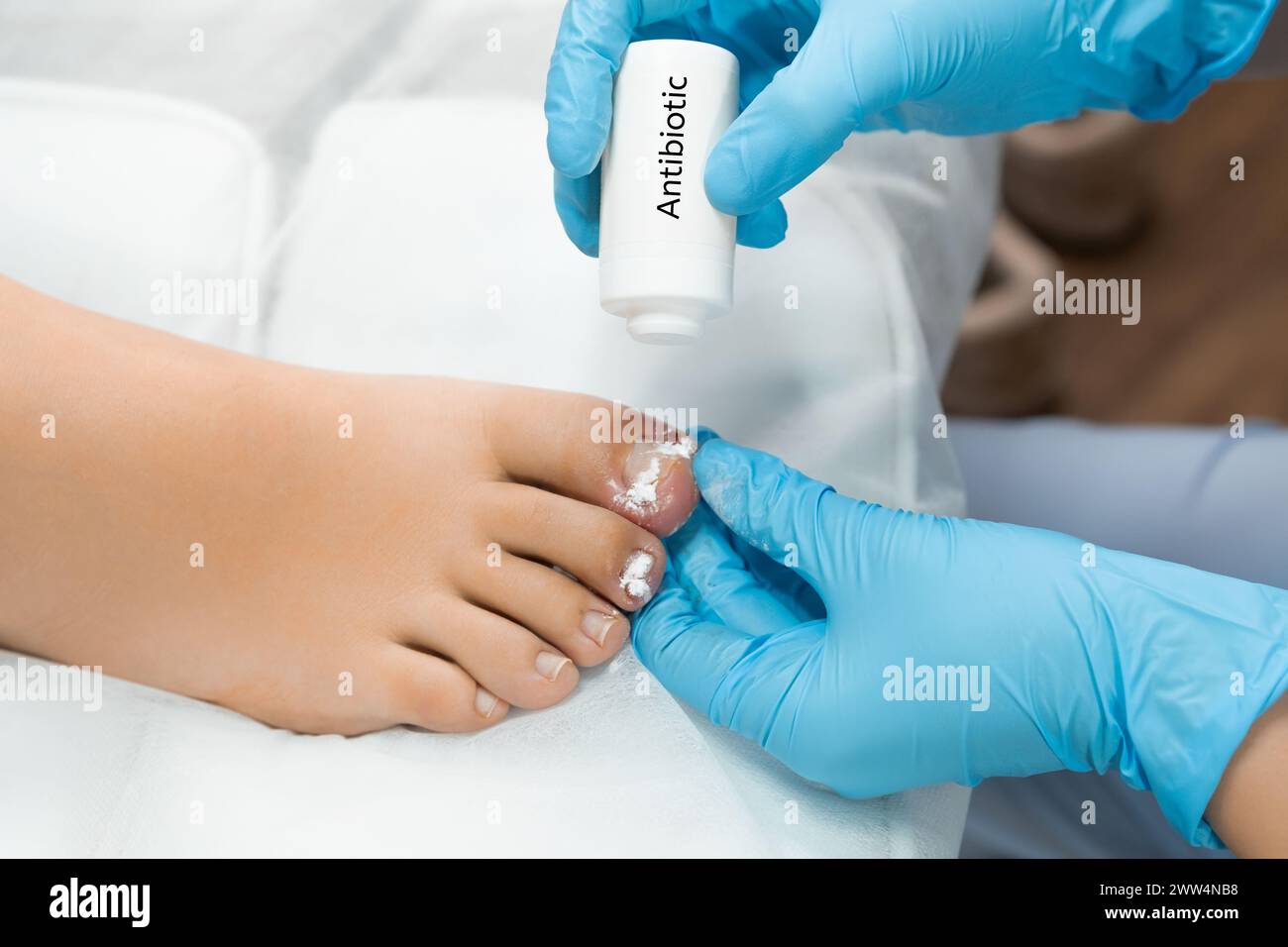Podologist uses antibiotic powder after removal of ingrown toe nail ...