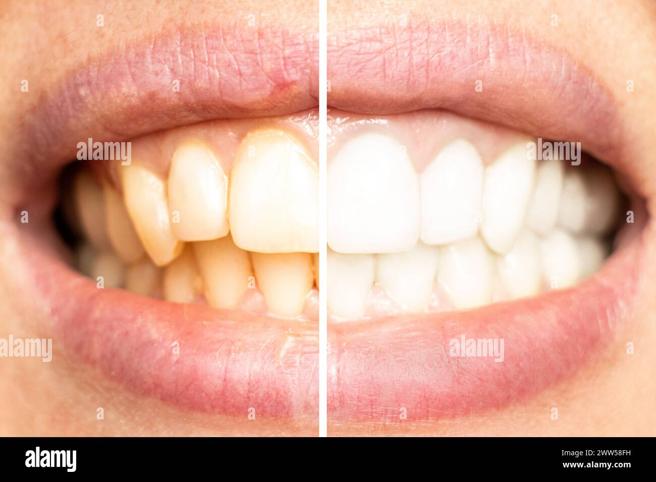 A girl s teeth before and after the dentist, example, close-up teeth ...