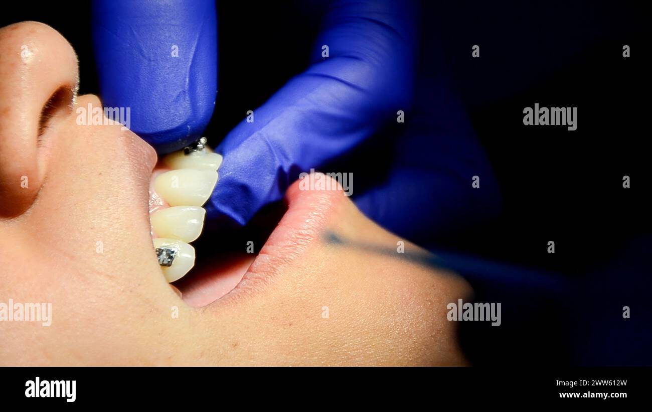Dentist using shade guide to match tooth color during dental ...