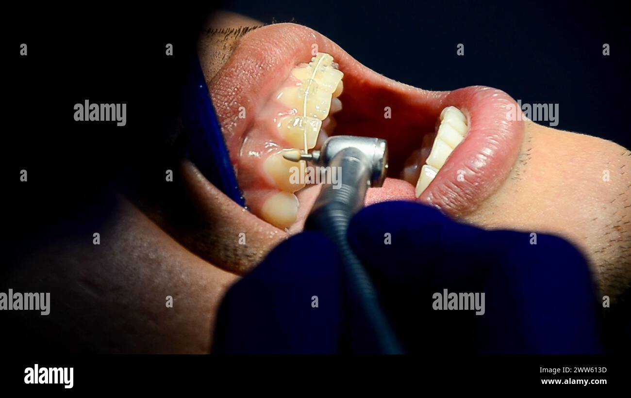 Enamel filling hi-res stock photography and images - Alamy