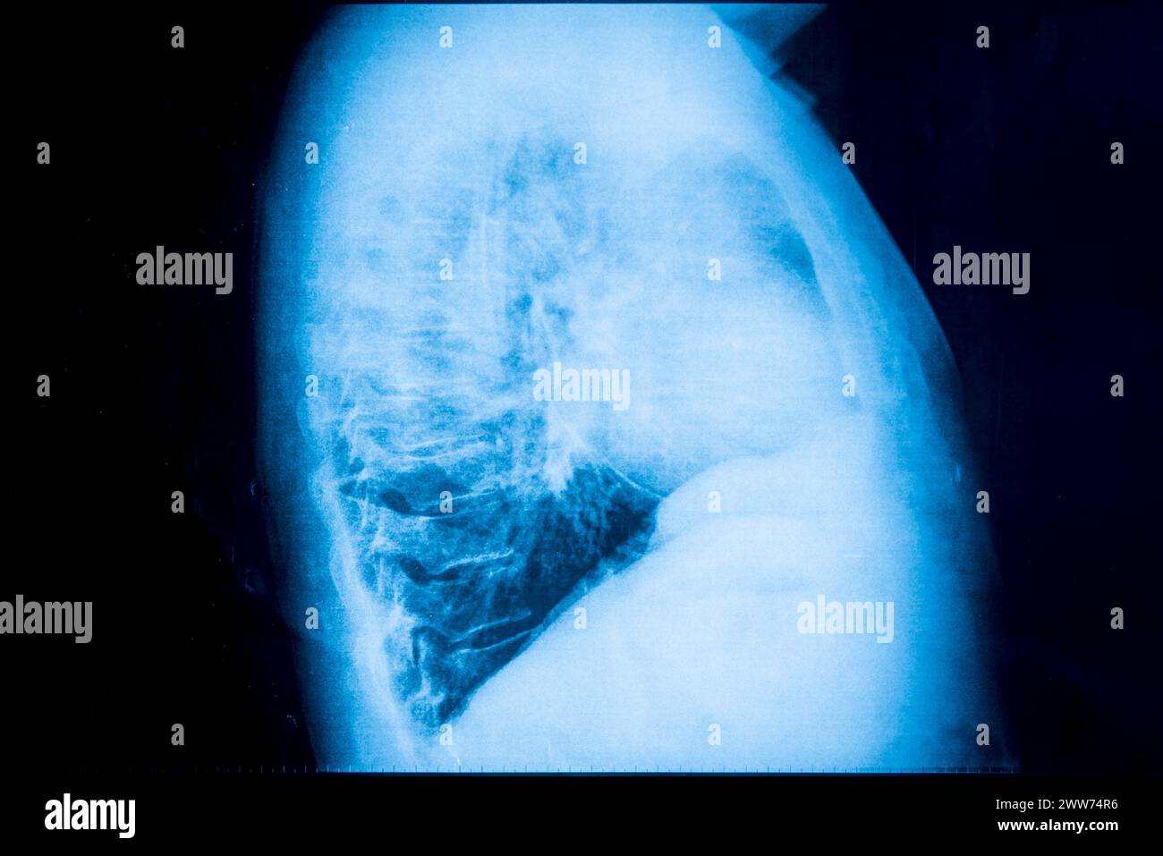 Profile x-ray of lungs Stock Photo - Alamy
