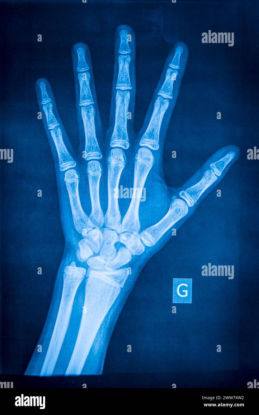 Normal left hand radiograph Stock Photo - Alamy