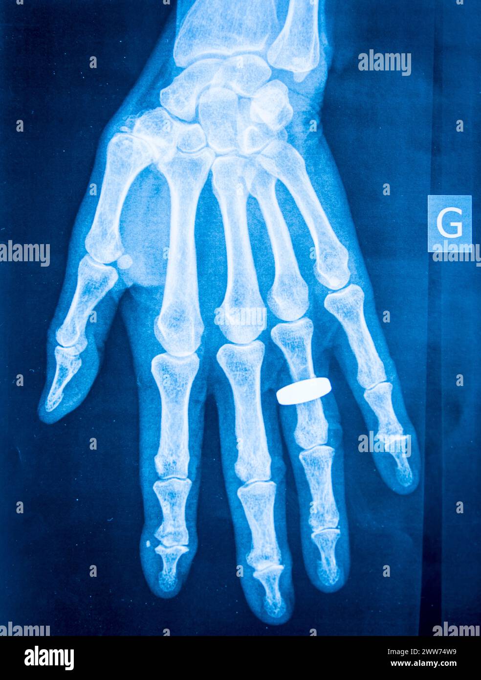 Hand x ray ring hi-res stock photography and images - Alamy