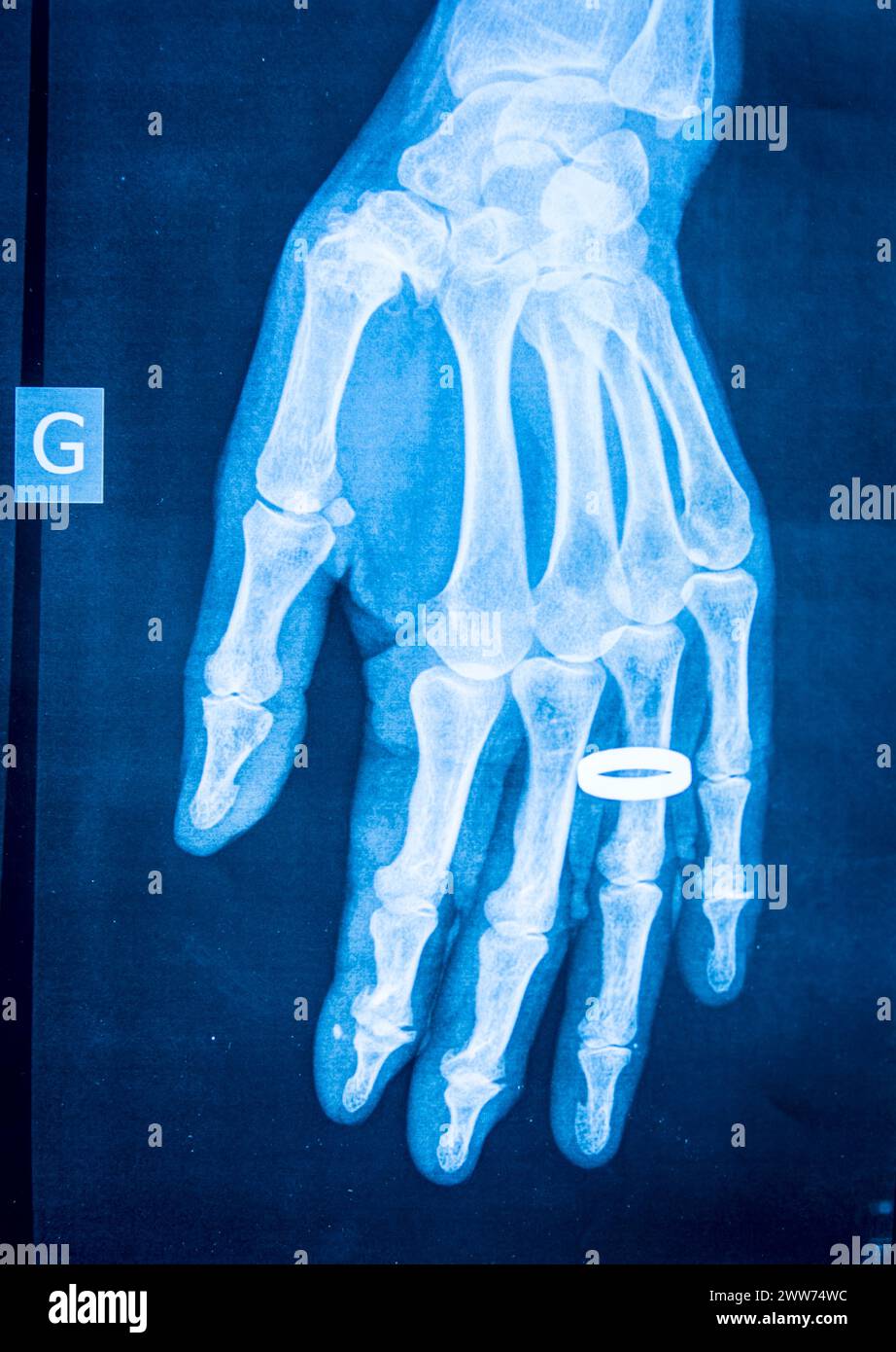Hand x ray ring hi-res stock photography and images - Alamy