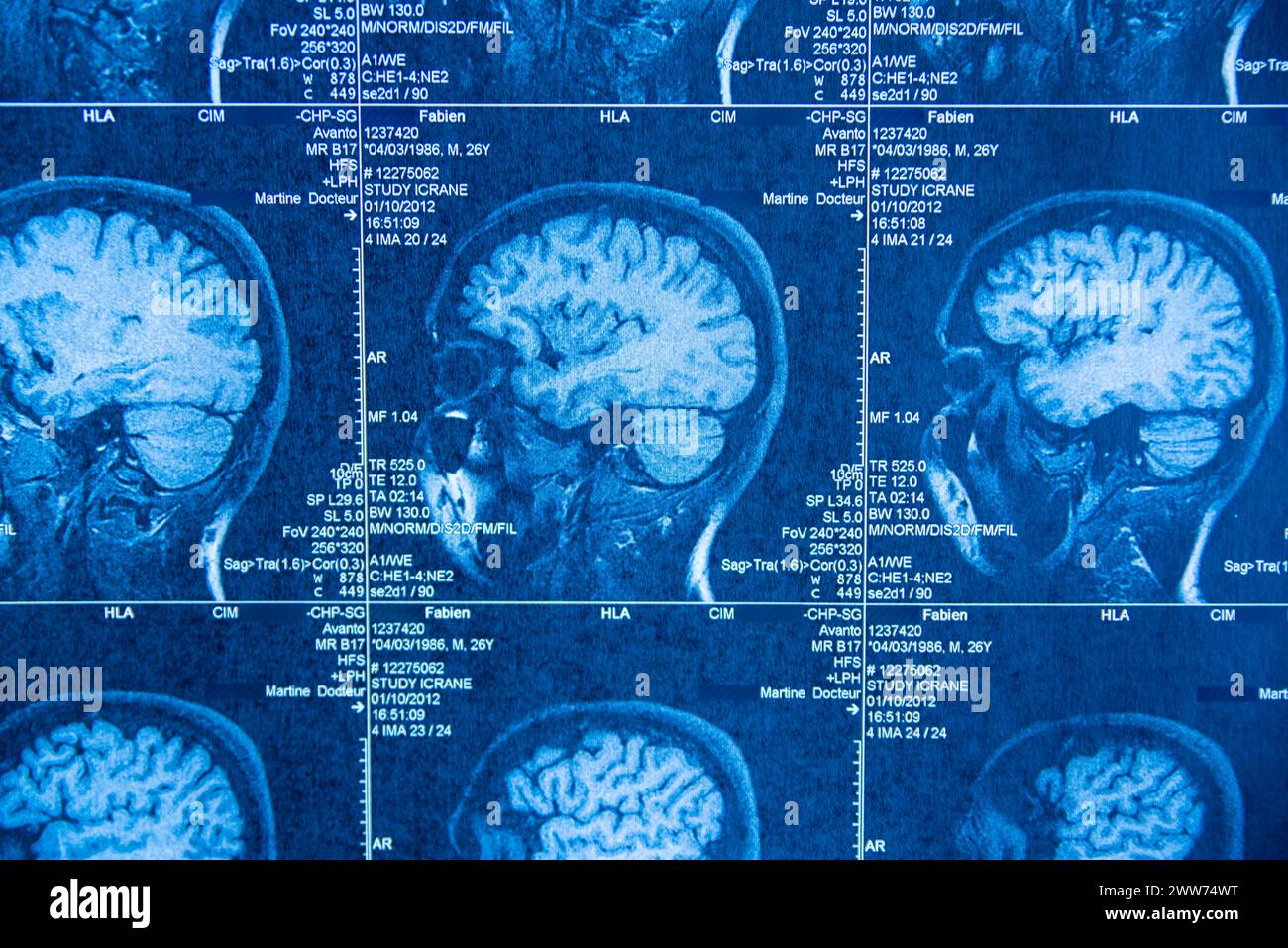 Tomography of the brain obtained by scanner Stock Photo - Alamy