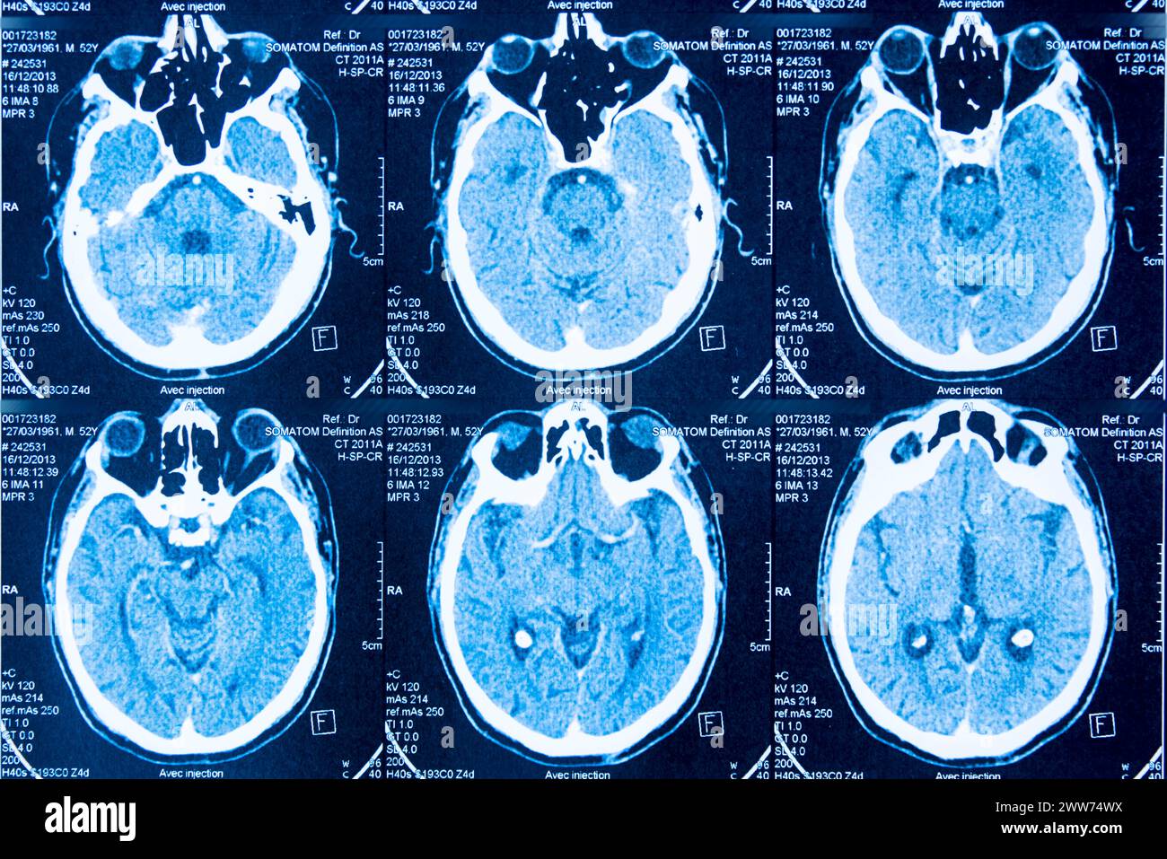 Tomography human brain in hi-res stock photography and images - Alamy