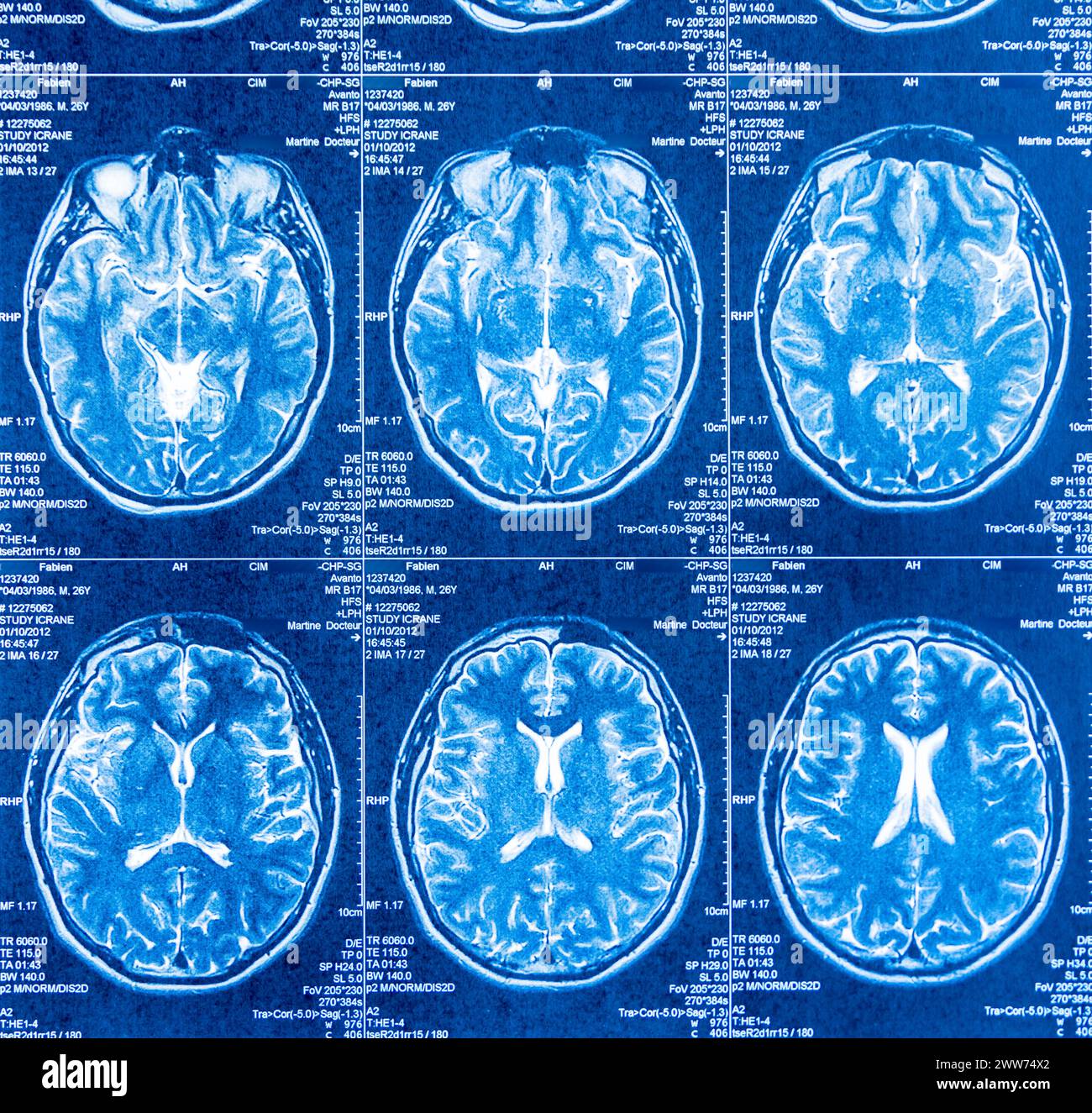 Tomography of the brain obtained by scanner Stock Photo - Alamy