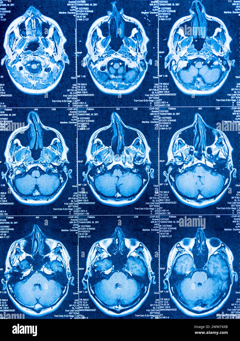 Tomography of the brain obtained by scanner Stock Photo - Alamy