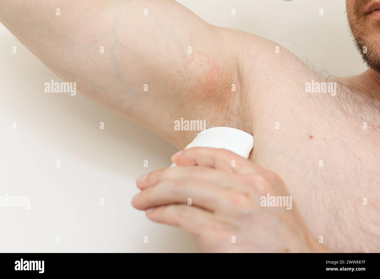 Young man with irritation, inflammation on sensitive underarm skin ...