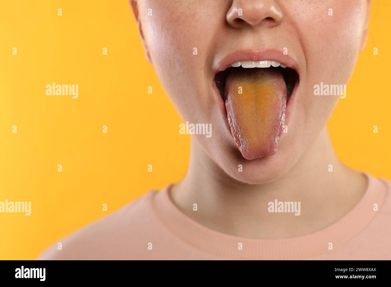 Gastrointestinal diseases. Woman showing her yellow tongue on color ...