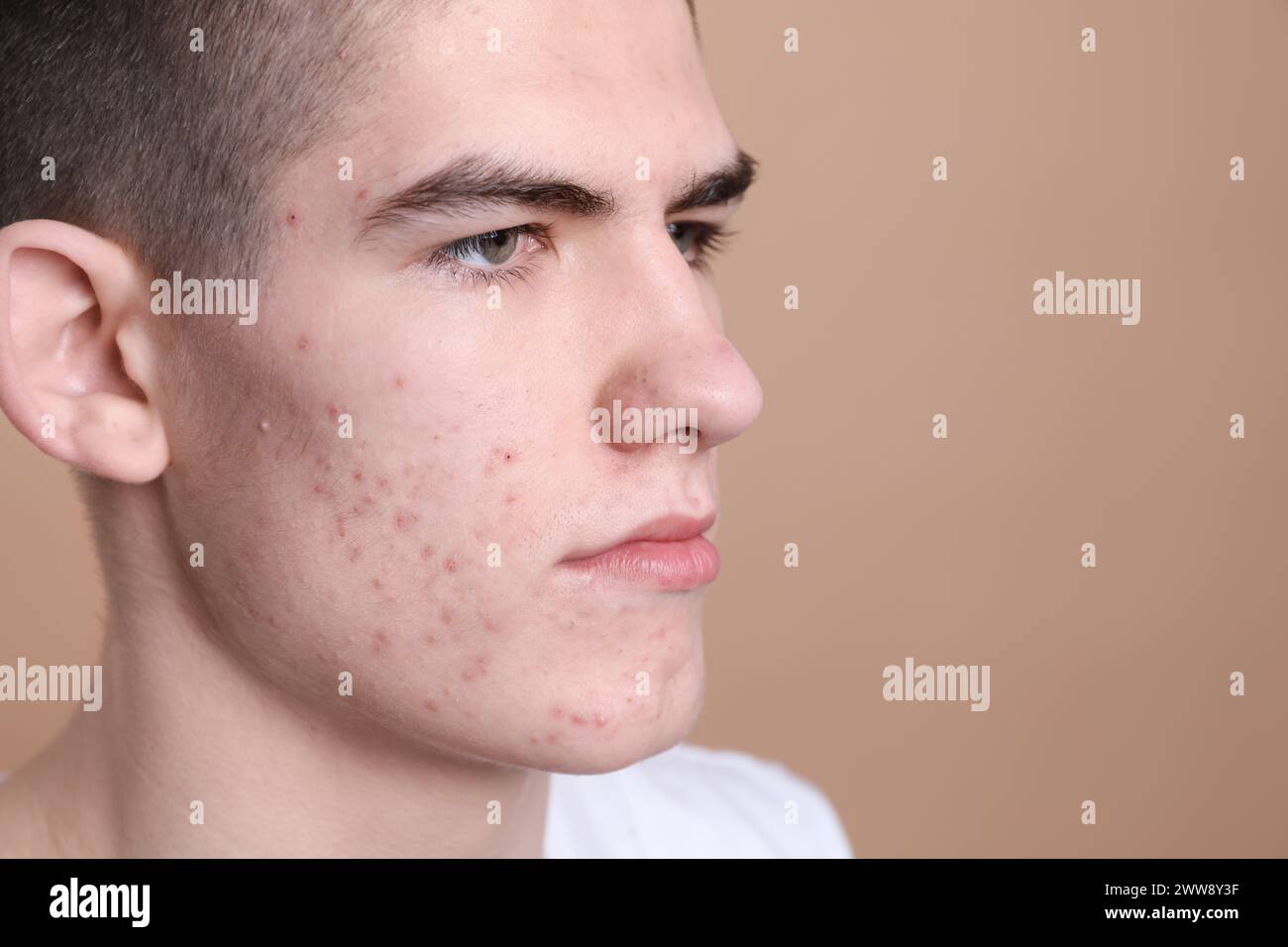Young man with acne problem on beige background, closeup. Space for ...