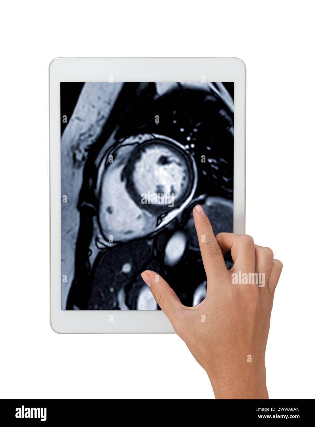 Cardiac MRI images on Tablet are instrumental in assessing cardiac ...