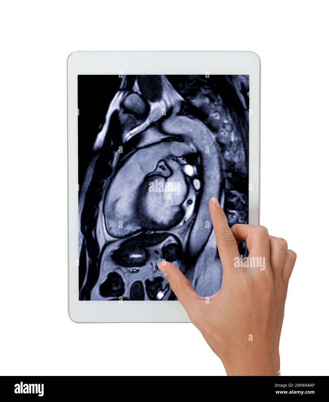 Cardiac MRI images on Tablet are instrumental in assessing cardiac ...