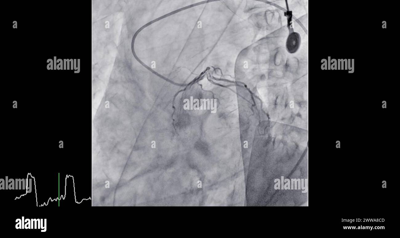 Cardiac Catheterization is a medical procedure used to examine the ...