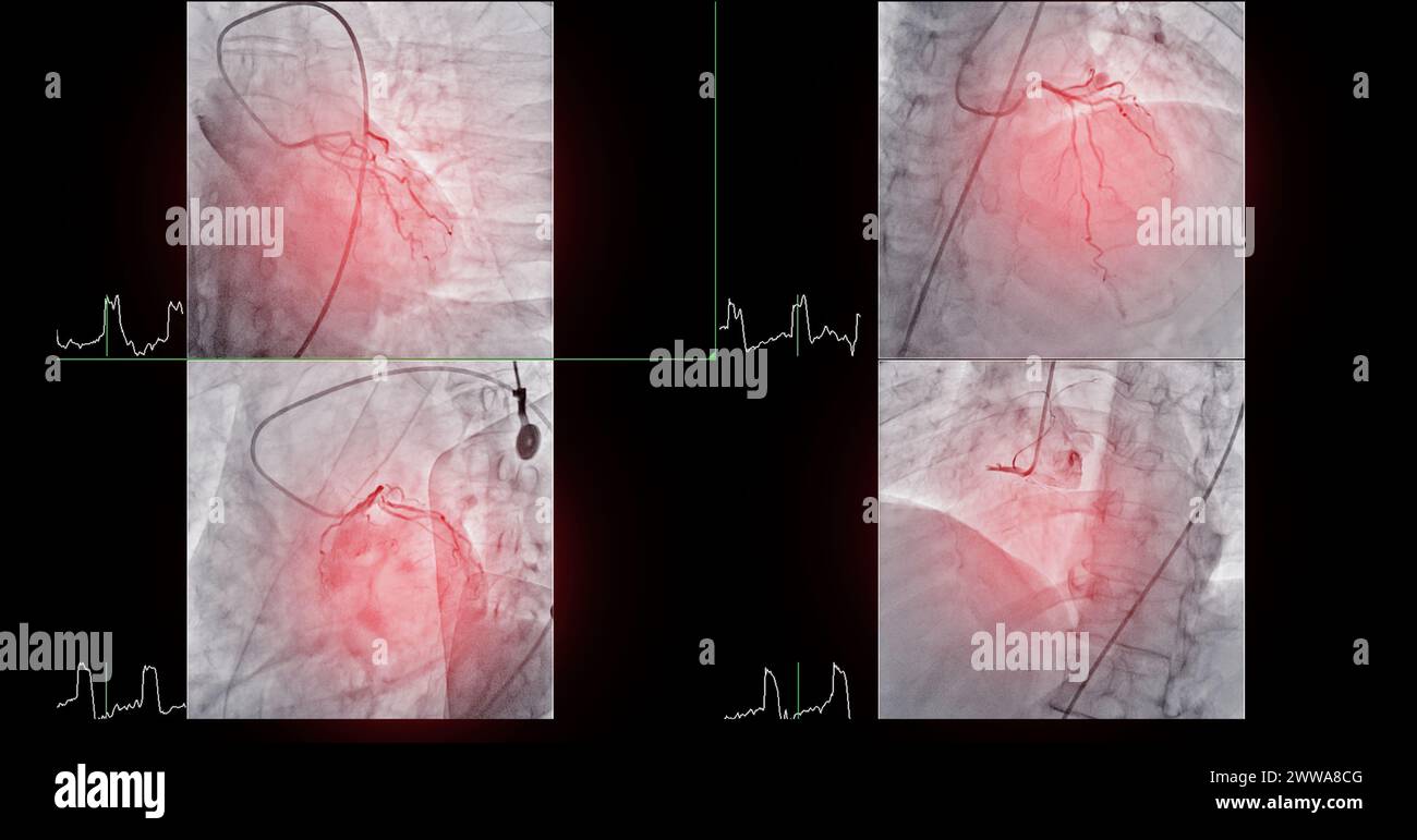 Cardiac Catheterization is a medical procedure used to examine the ...