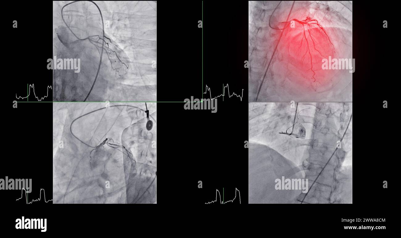 Cardiac Catheterization is a medical procedure used to examine the ...