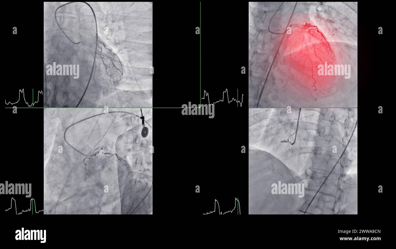 Coronary artery evaluation hi-res stock photography and images - Alamy