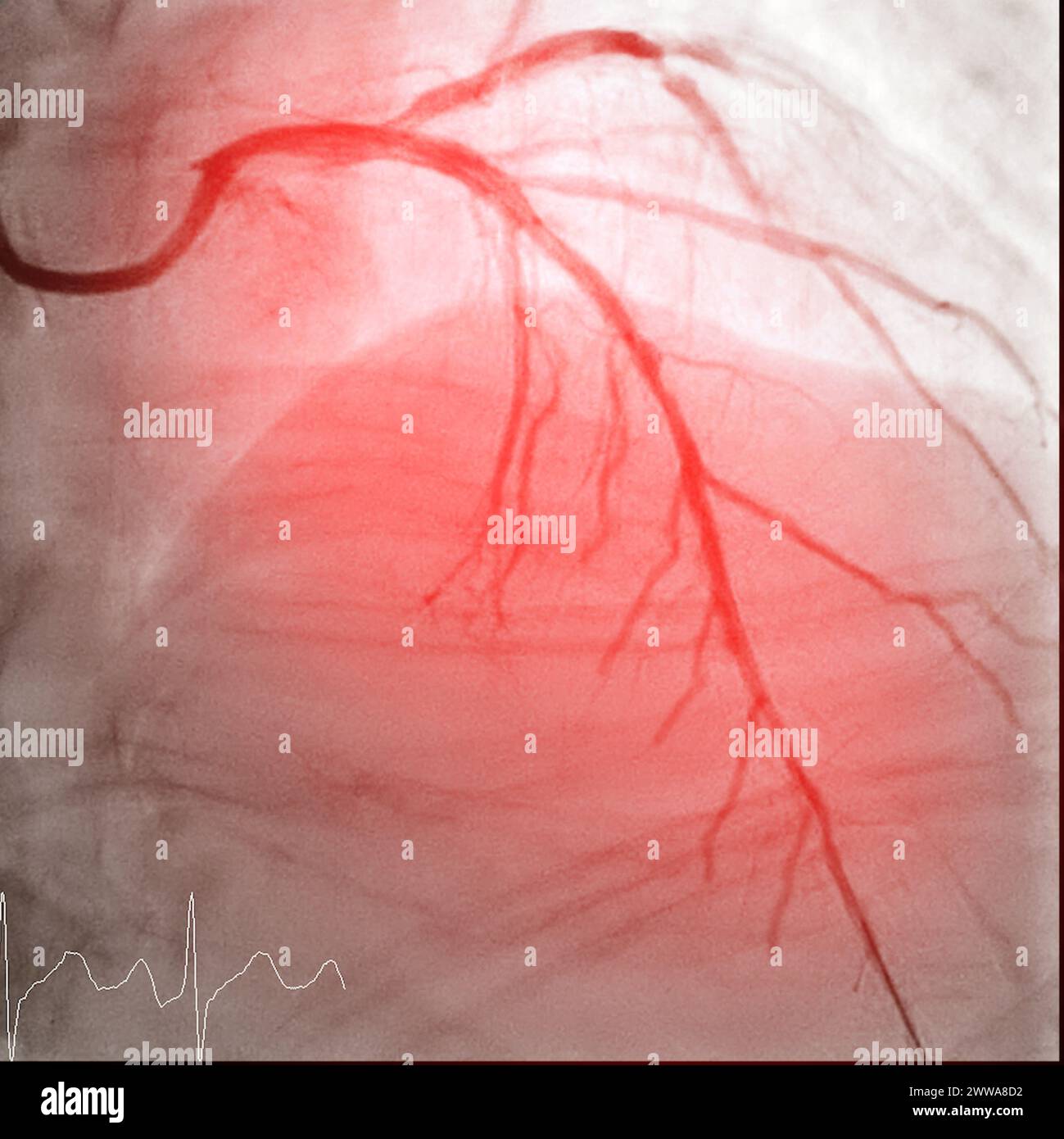 Cardiac Catheterization is a medical procedure used to examine the ...