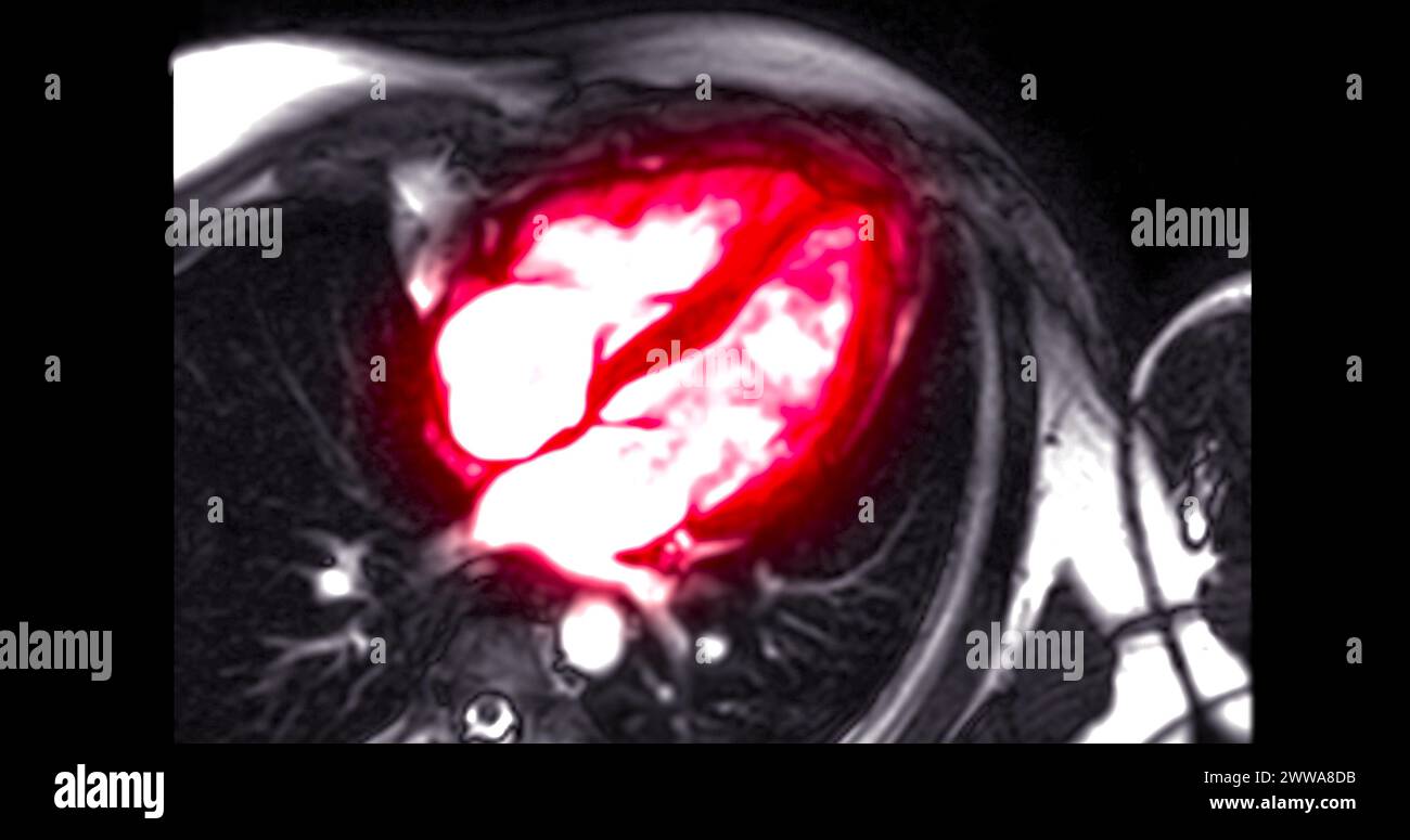 Cardiac MRI evaluates heart health, providing detailed images for ...