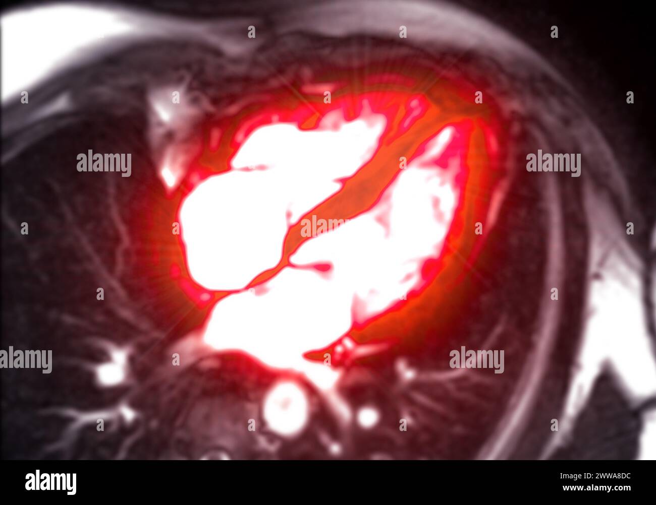 Cardiac MRI evaluates heart health, providing detailed images for ...