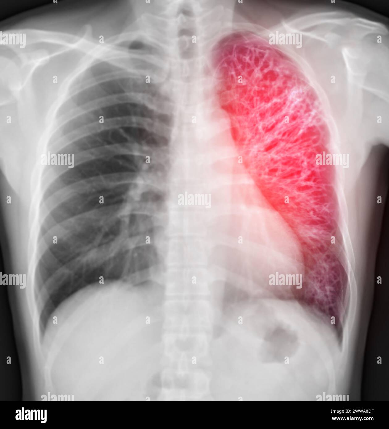 Chest X-ray Of Human Chest or Lung fusion with CT scan 3D Stock Photo ...