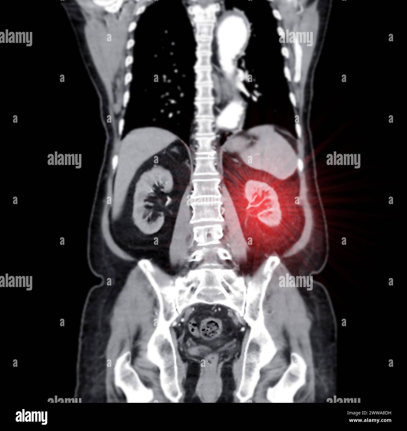 CT scan of whole abdomen with injection contrast media in coronal view ...