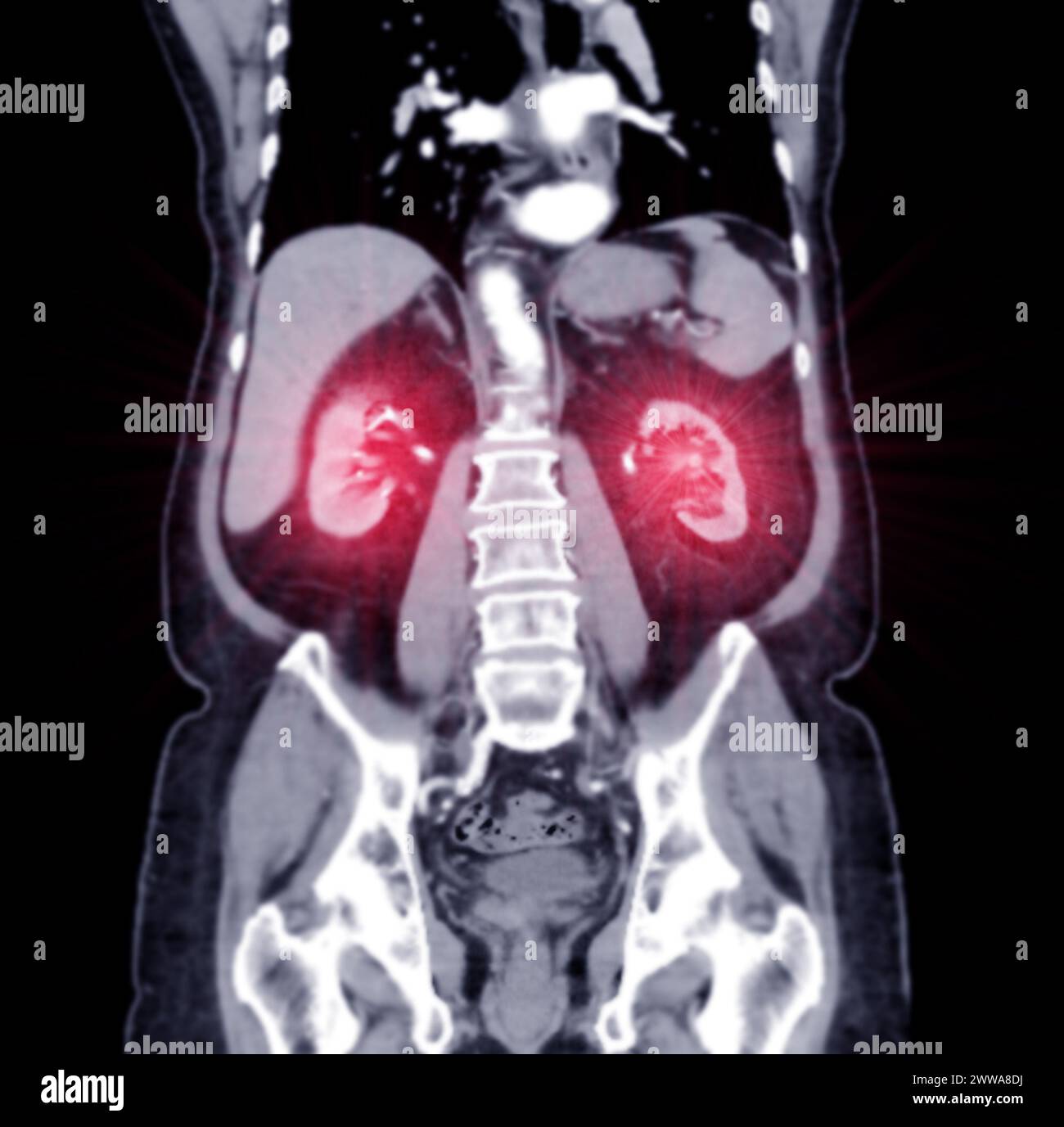Bowel obstruction scan hi-res stock photography and images - Alamy