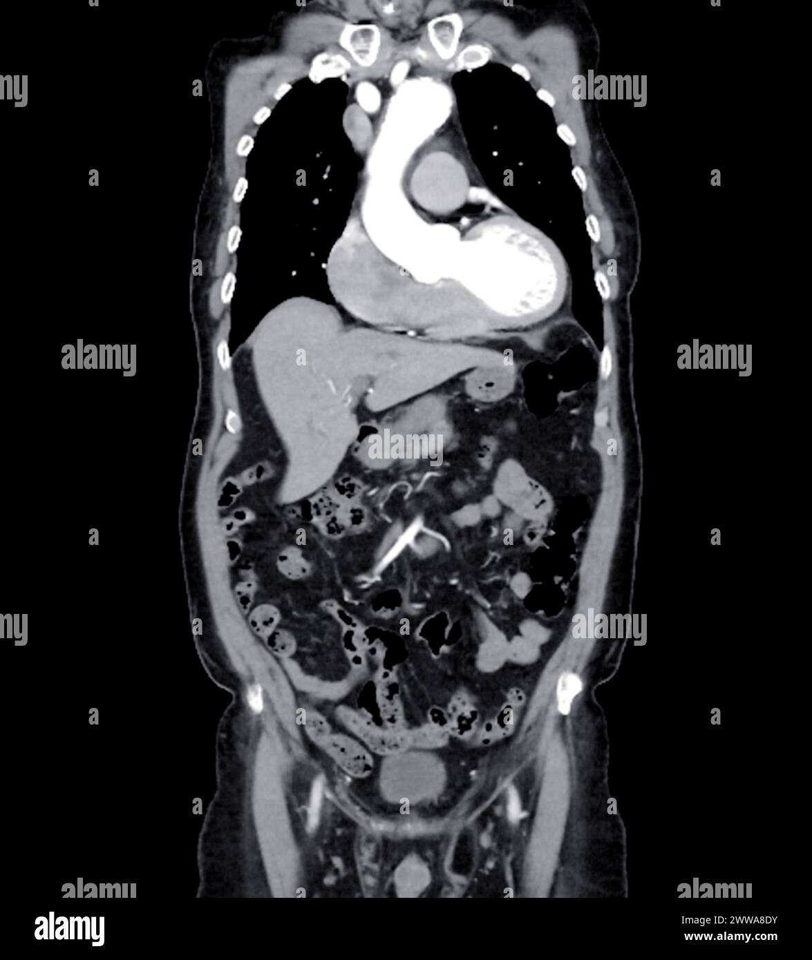 CTA whole aorta imaging coronal view displaying an aortic aneurysm ...