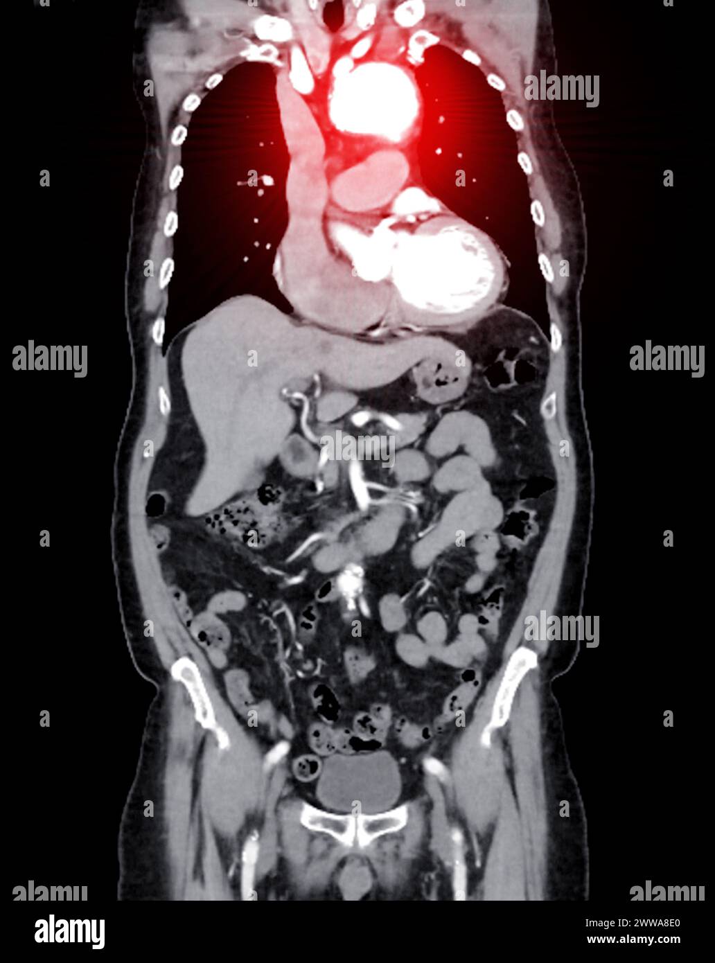 CTA whole aorta imaging coronal view displaying an aortic aneurysm ...