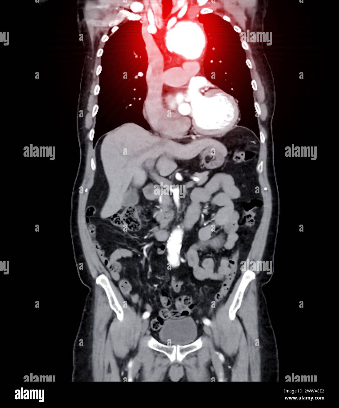 CTA whole aorta imaging coronal view displaying an aortic aneurysm ...