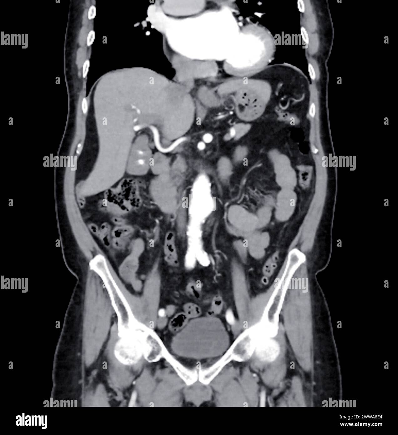 CT scan of whole abdomen with injection contrast media in coronal view ...