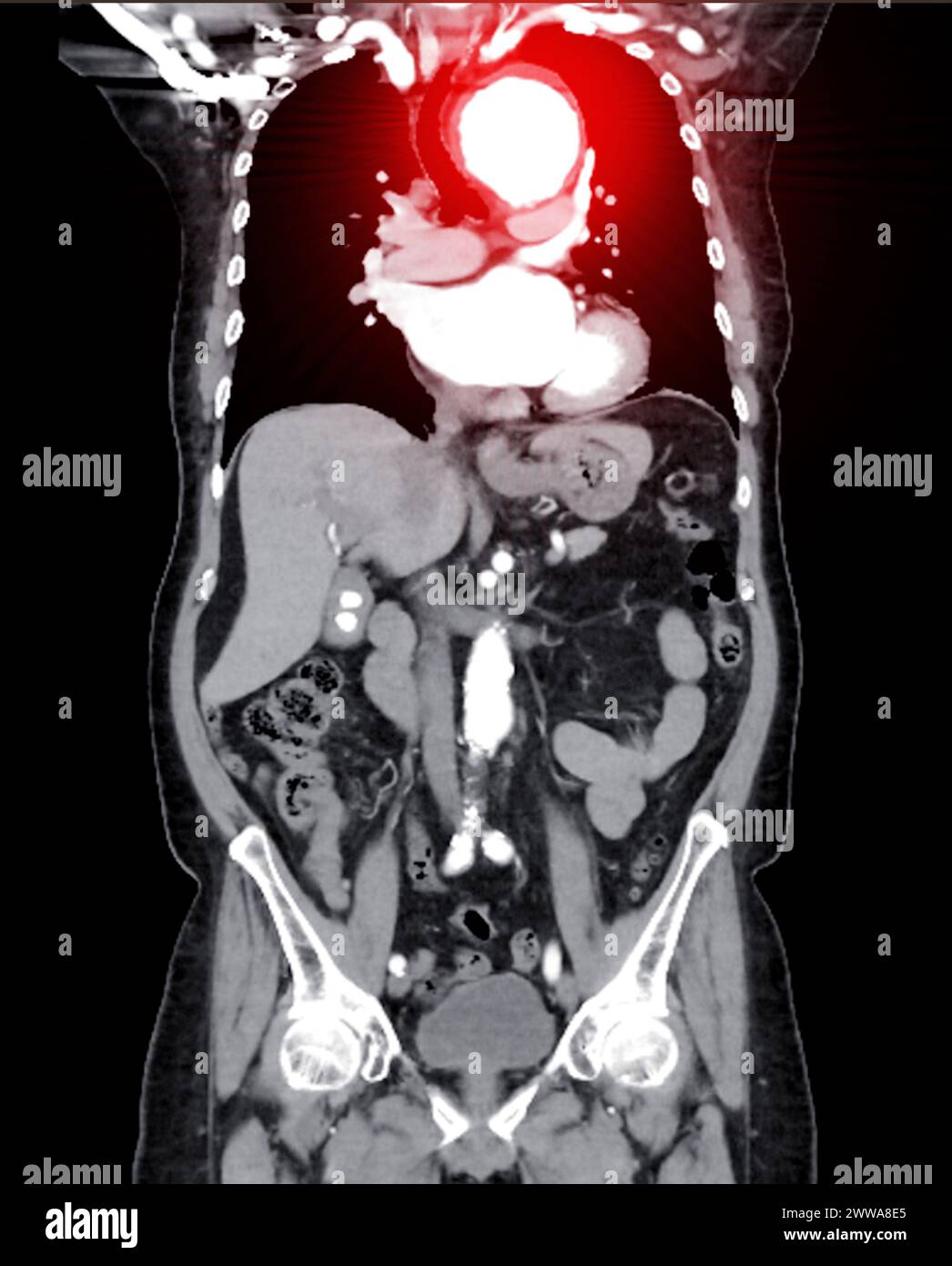 CTA whole aorta imaging coronal view displaying an aortic aneurysm ...