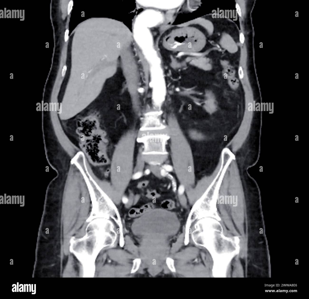 CT scan of whole abdomen with injection contrast media in coronal view ...