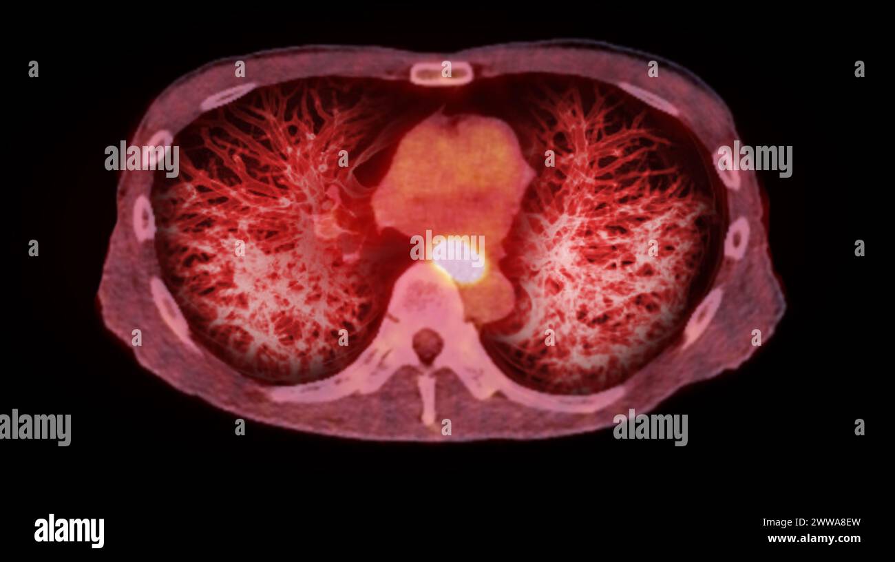 CT Chest or Lung 3d rendering image showing Trachea and lung in ...