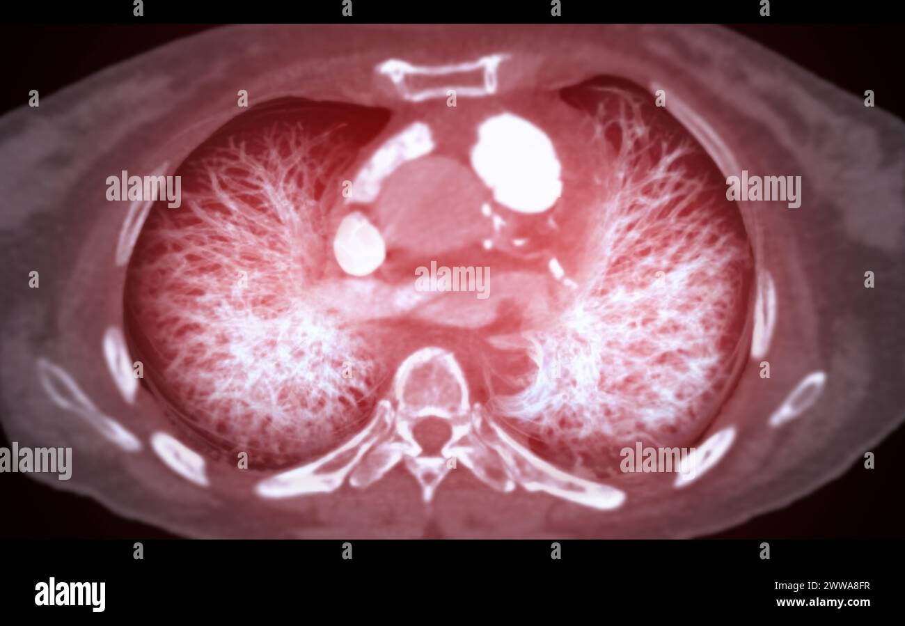 CT Chest or Lung 3d rendering image showing Trachea and lung in ...