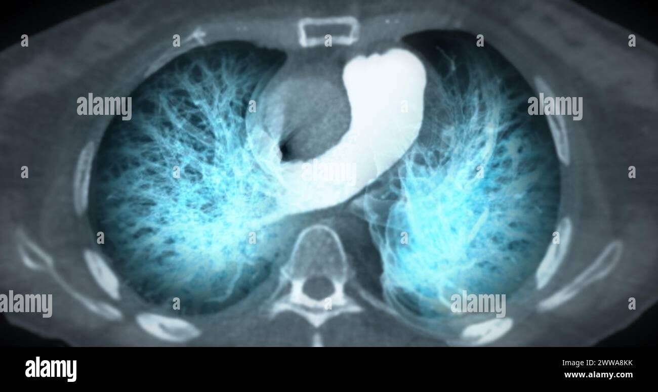 CT Chest or Lung 3d rendering image showing Trachea and lung in ...