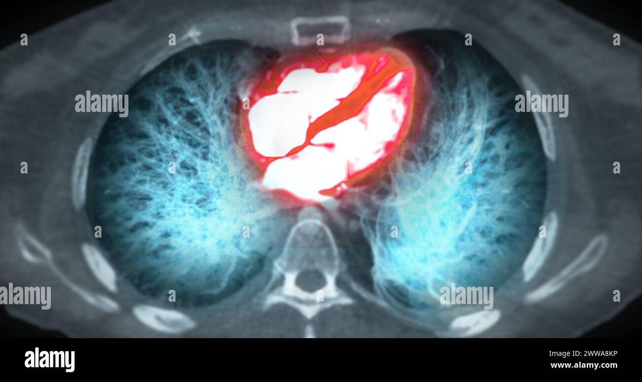 CT Chest or Lung 3d rendering image showing Trachea and lung in ...