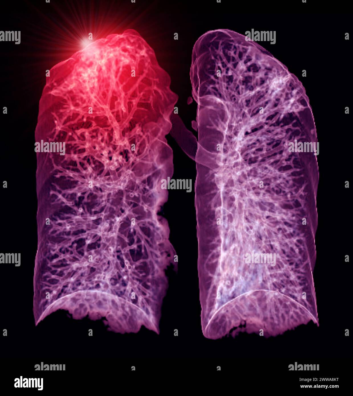 A CT chest 3D scan displaying a lesion at the right upper lobe offers a ...