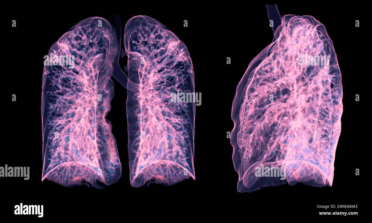 A CT chest 3D scan displaying a lesion at the right upper lobe offers a ...