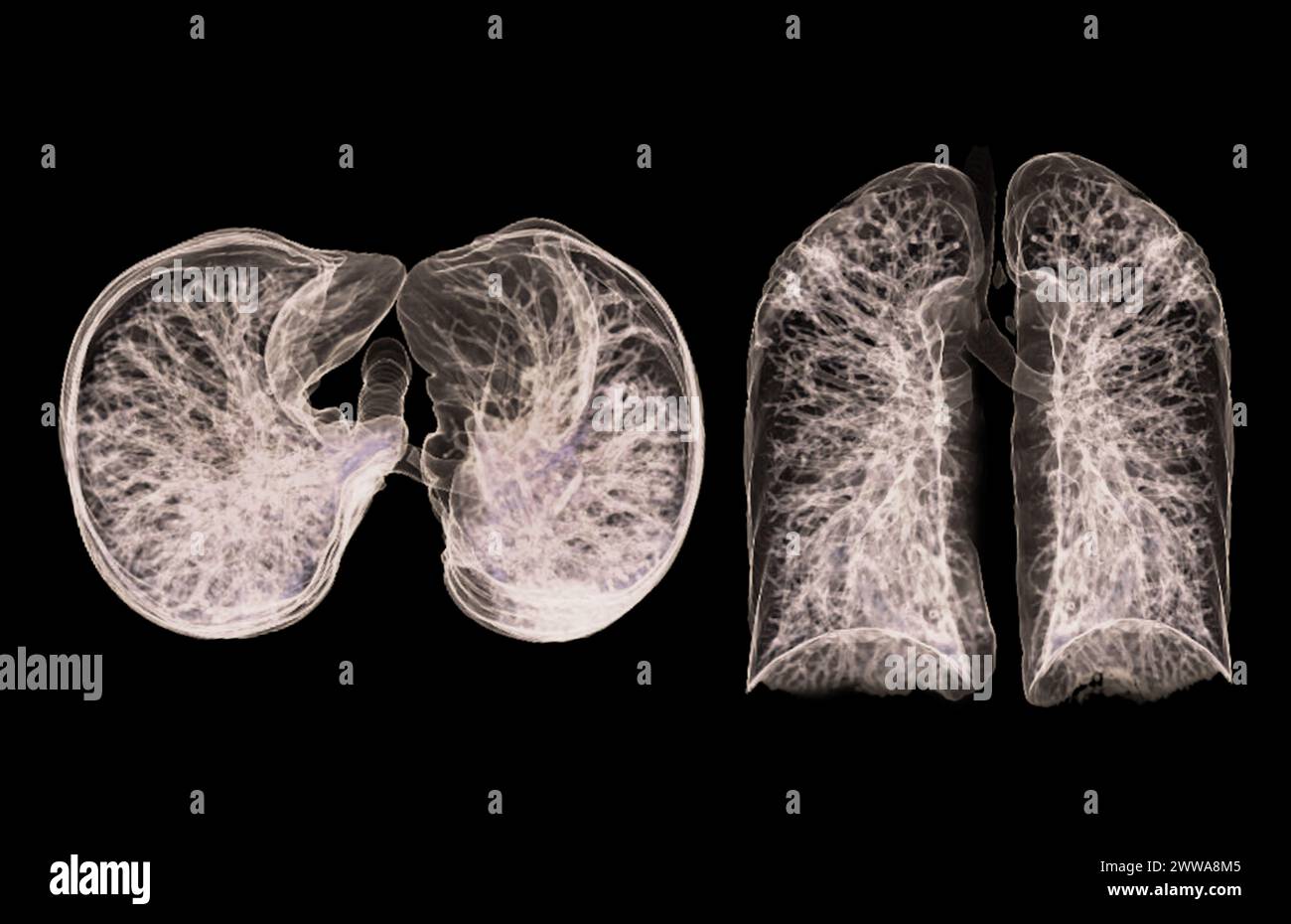 A CT chest 3D scan displaying a lesion at the right upper lobe offers a ...