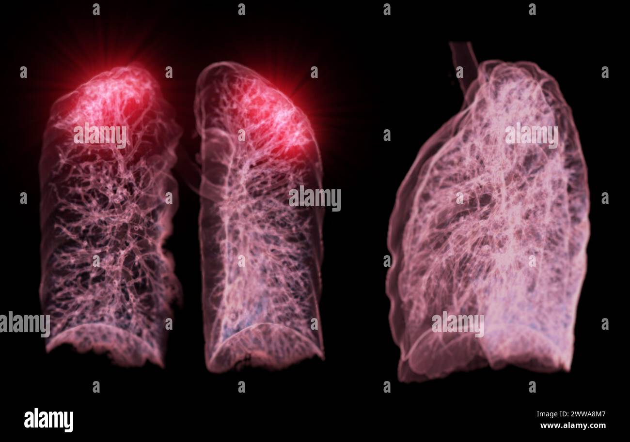 A CT chest 3D scan displaying a lesion at the right upper lobe offers a ...