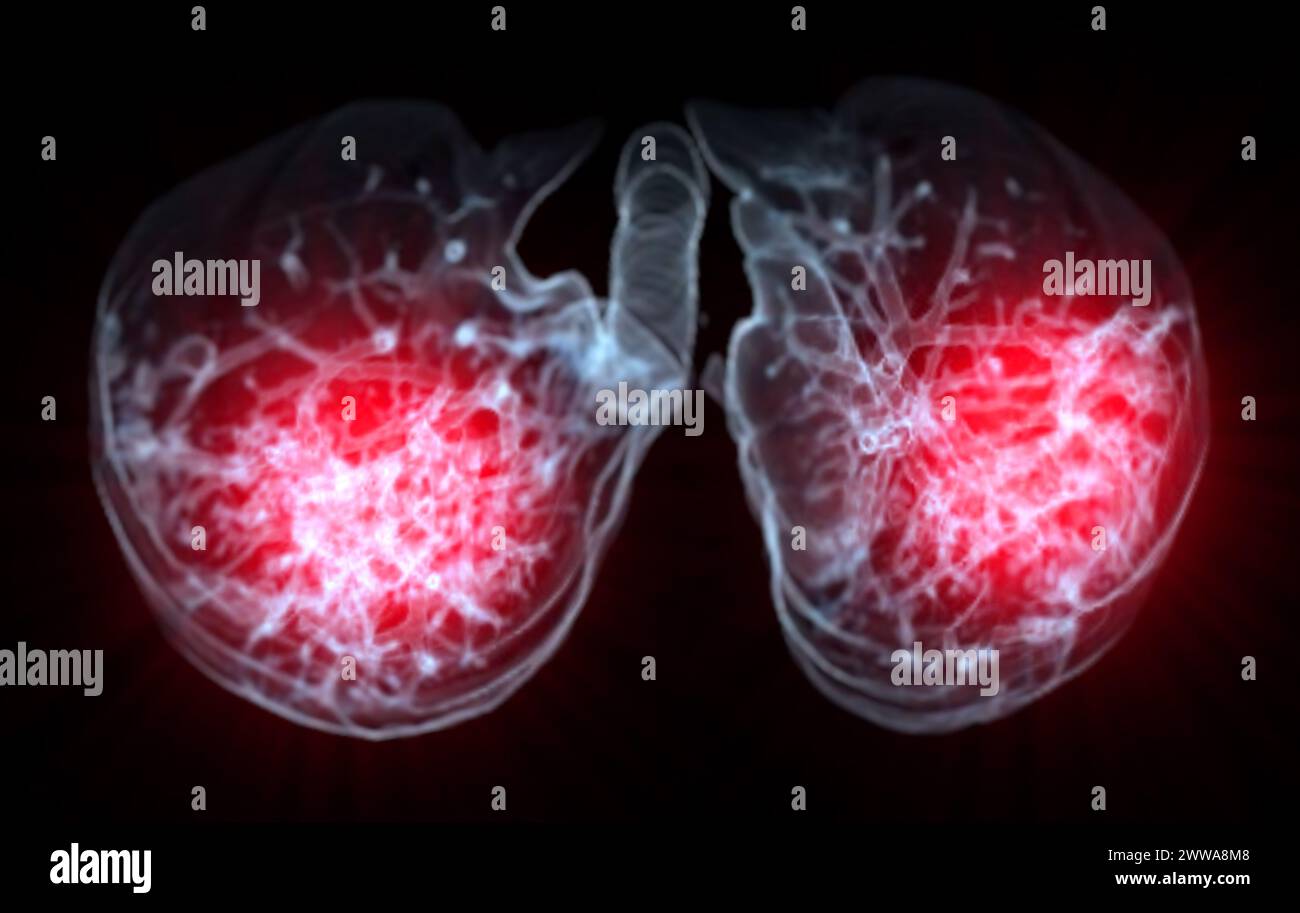 CT Chest or Lung 3d rendering image showing Trachea and lung in ...
